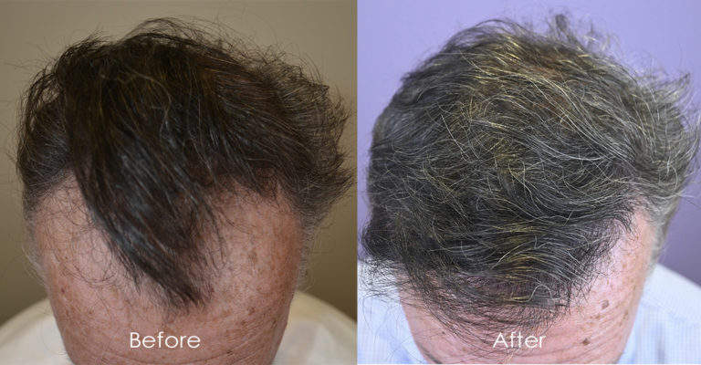 Video Comb-through Case Study - Norwood Class 3 - Hair Restoration of ...
