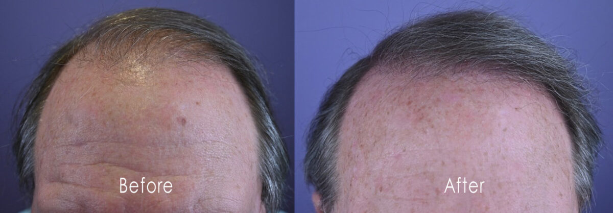 "Boomerang" Hair Transplant Pattern - Hair Restoration of the South
