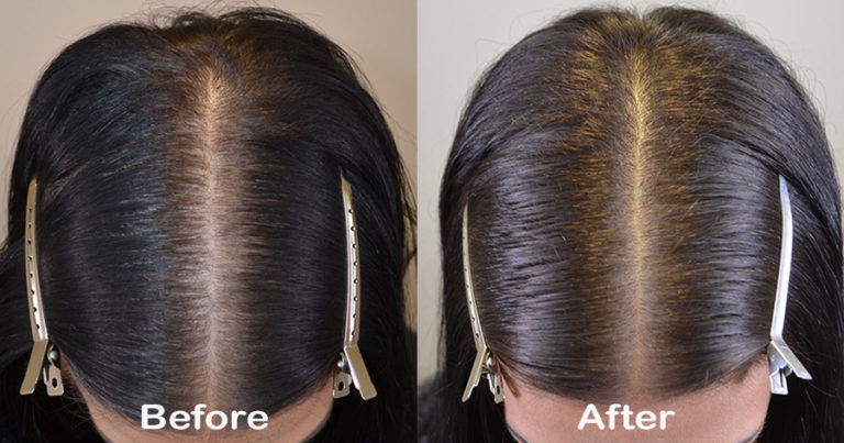 ACell + PRP and Oral Minoxidil For Female Hair Loss - Hair Restoration ...