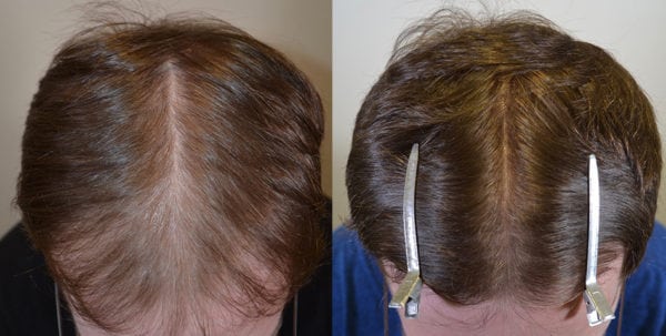 Propecia before and after photos - Dr Rogers - New Orleans