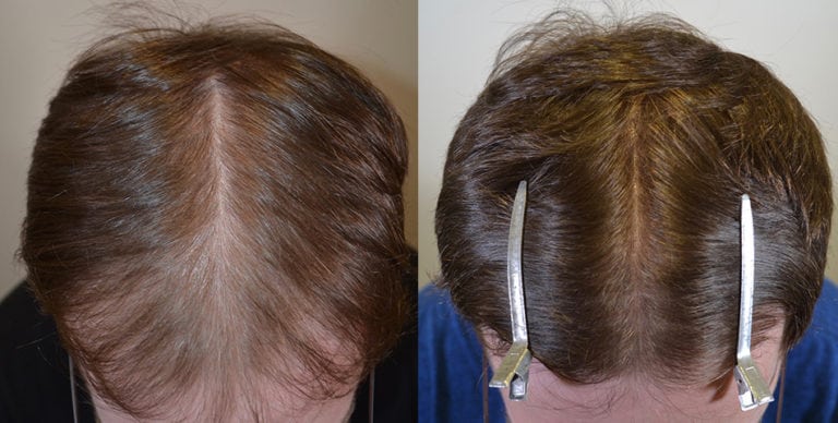 Great Finasteride Results - 1 Year Follow Up - Hair Restoration of the ...