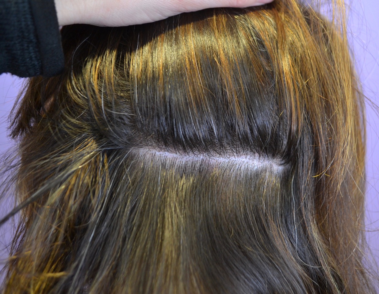 Female Hairline And Temporal Restoration Hair Restoration Of The South
