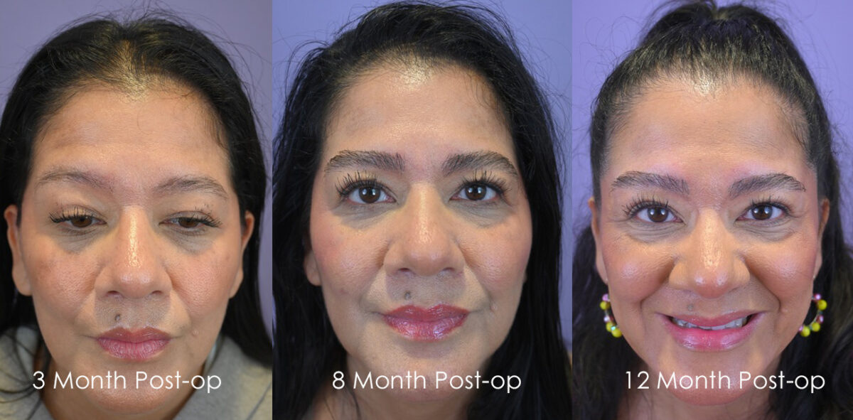 Eyebrow Hair Restoration Case Study Over 1 Year - Hair Restoration of ...