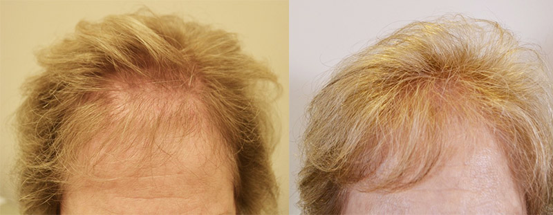 Female Hair Transplant - 1800 grafts - Hair Restoration of the South