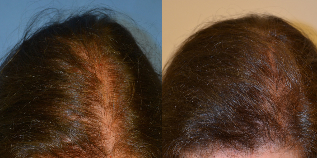Hair Transplant Before and After Photos: Women - Hair Restoration of ...