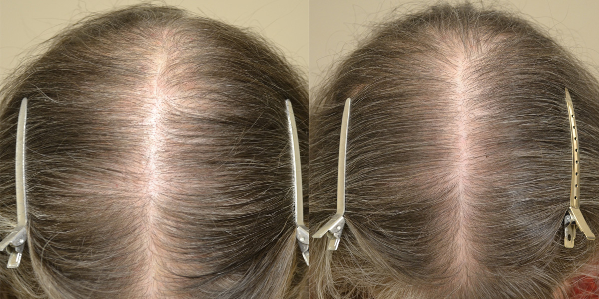 Finasteride (Females) Before & After Photos - Hair Restoration of the ...