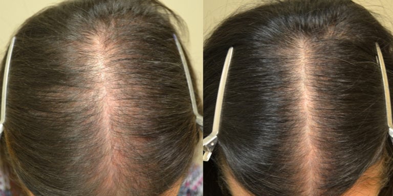 Spironolactone (For Females only) Before & After Photos - Hair ...
