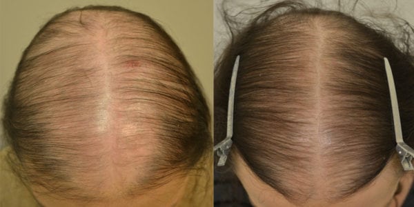 Spironolactone (For Females only) Before & After Photos - Hair ...