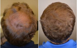 Propecia before and after photos - Dr Rogers - New Orleans