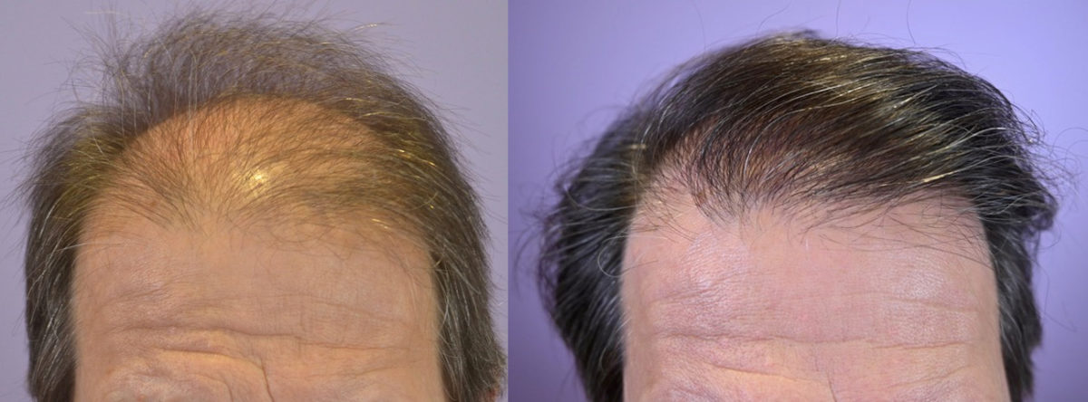 Hair Transplant on 64 Year Old Male with Diffuse Hair Loss - Hair ...