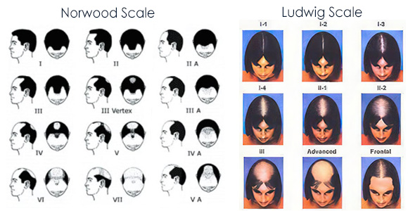 "Boomerang" Hair Transplant Pattern - Hair Restoration of the South