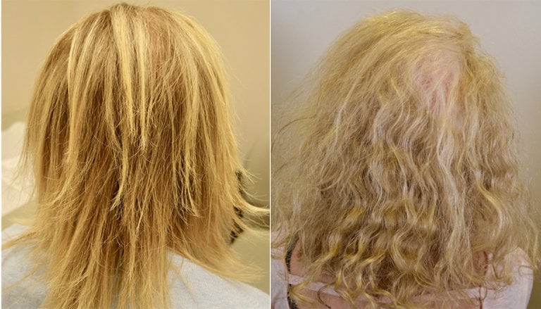 Fabulous Hair Transformation - Hair Restoration of the South