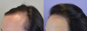 Female Hairline Recession Restored - Hair Restoration of the South
