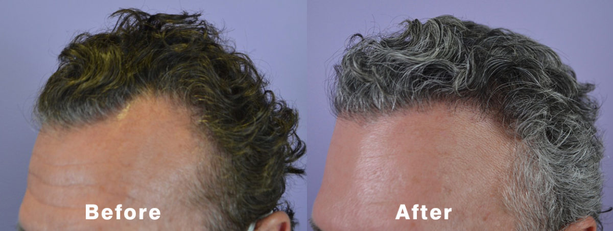 Hairline Restored - Hair Restoration of the South