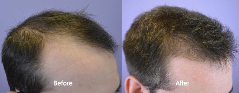 Low Dose Minoxidil Pill Prescribed For Early Hair Loss - Hair ...