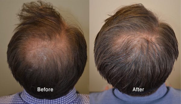 Topical Minoxidil Hair Growth Results Impressive Minoxidil Results ...