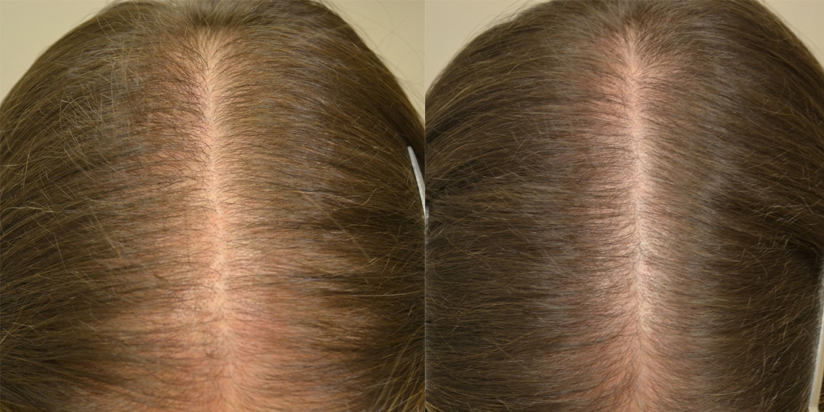 Topical Minoxidil Females Before And After Photos Hair Restoration Of