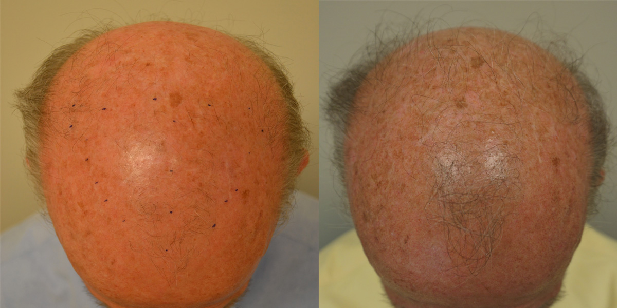 Platelet Rich Plasma (PRP) Before & After Photos - Hair Restoration of ...