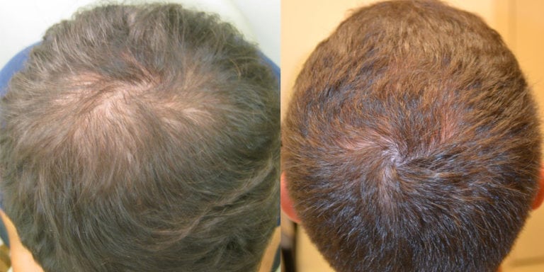 Propecia before and after photos - Dr Rogers - New Orleans