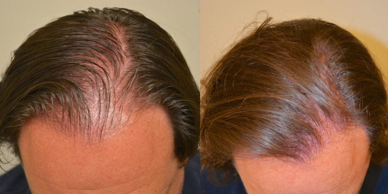 Propecia before and after photos - Dr Rogers - New Orleans