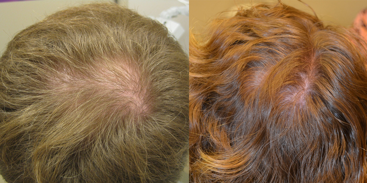 Propecia before and after photos - Dr Rogers - New Orleans