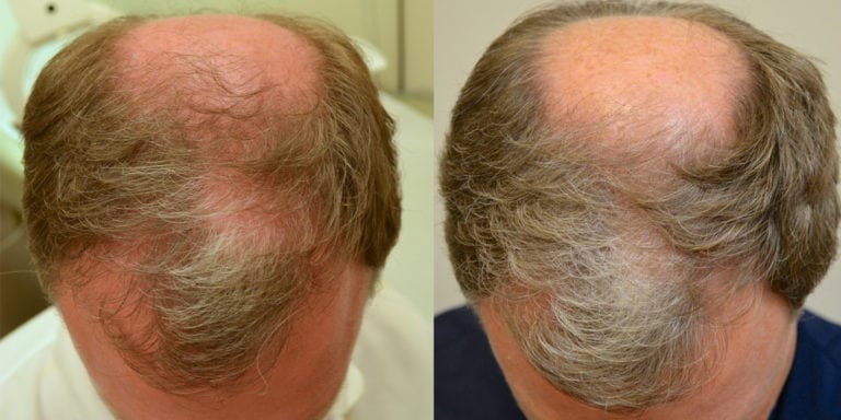 Propecia before and after photos - Dr Rogers - New Orleans