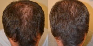 Propecia before and after photos - Dr Rogers - New Orleans