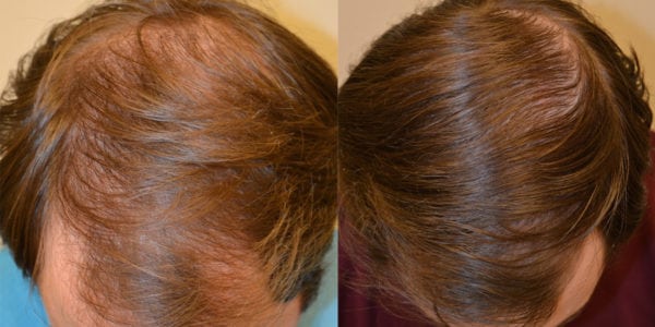 Propecia before and after photos - Dr Rogers - New Orleans