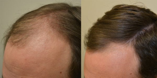 Propecia before and after photos - Dr Rogers - New Orleans