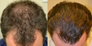 Propecia before and after photos - Dr Rogers - New Orleans