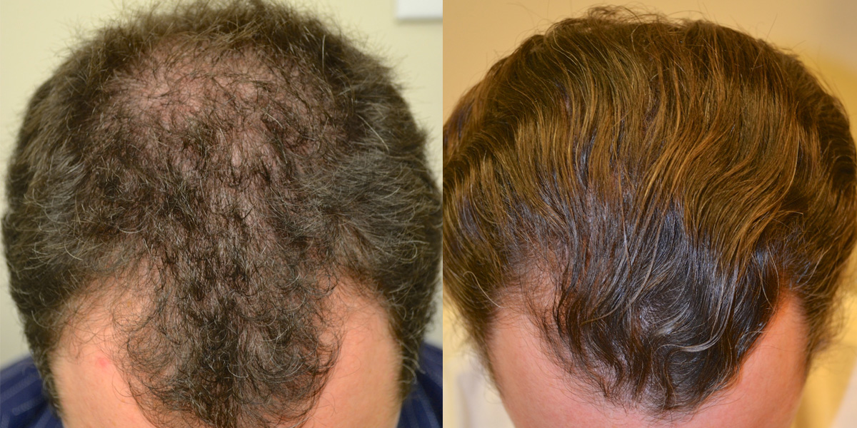 Propecia Before And After Photos Dr Rogers New Orleans