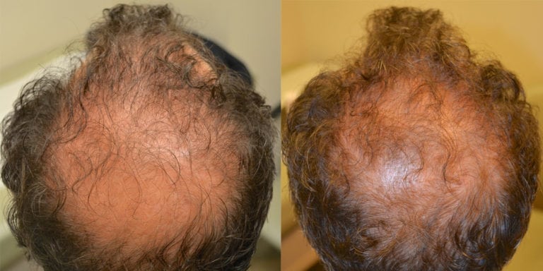 Propecia before and after photos - Dr Rogers - New Orleans