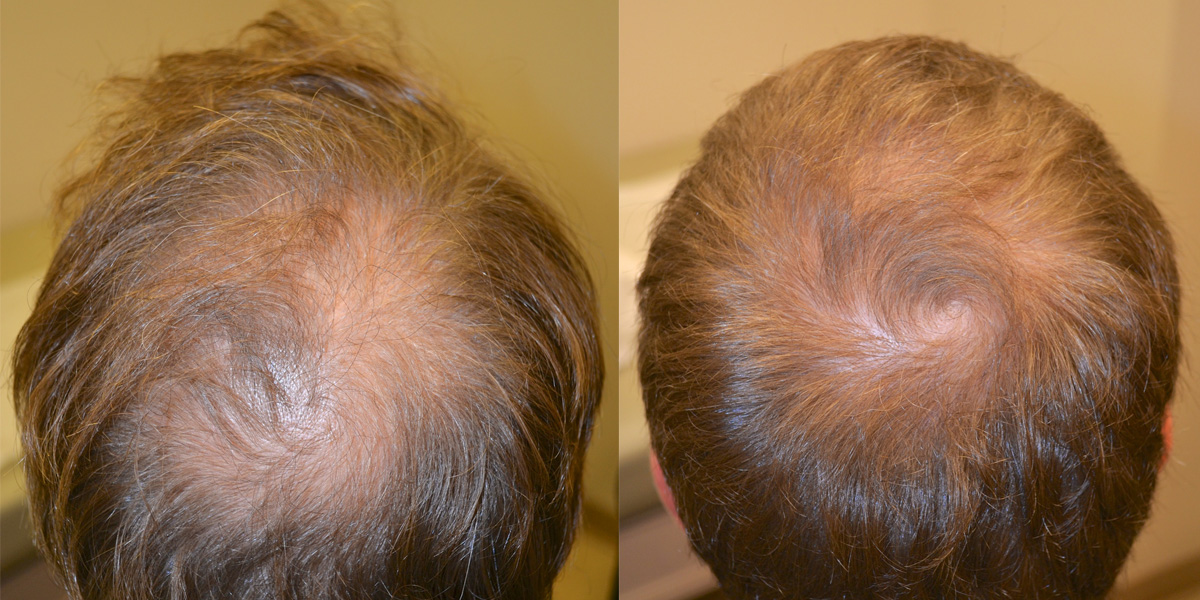 Propecia before and after photos - Dr Rogers - New Orleans