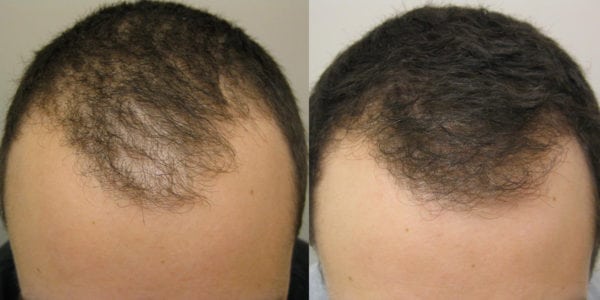 Propecia before and after photos - Dr Rogers - New Orleans