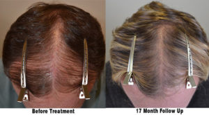 Propecia before and after photos - Dr Rogers - New Orleans