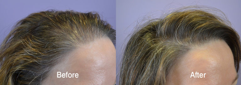 Female Hairline and Temporal Restoration - Hair Restoration of the South
