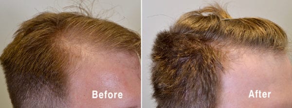 Propecia before and after photos - Dr Rogers - New Orleans