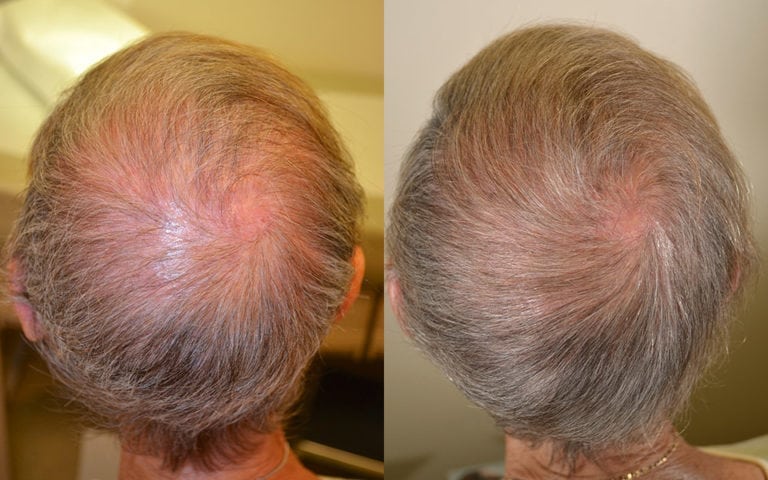 Finasteride (Females) Before & After Photos - Hair Restoration of the ...