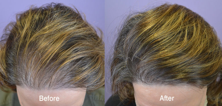 Female Hairline And Temporal Restoration Hair Restoration Of The South