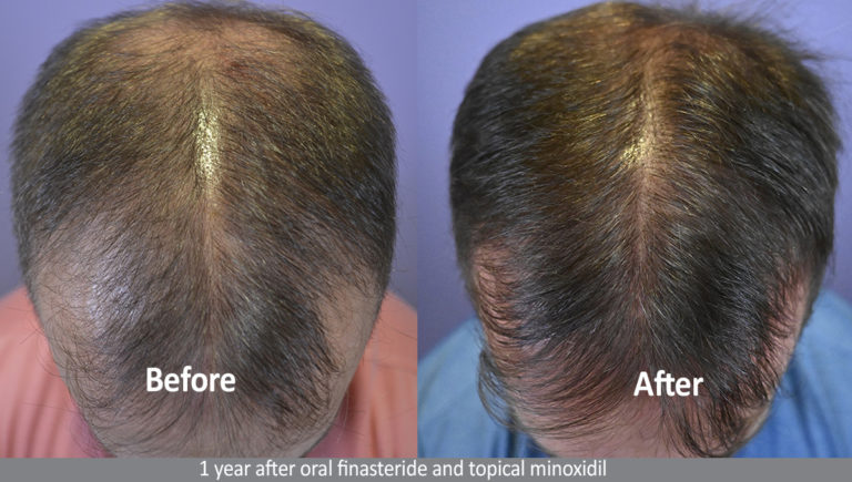 Propecia before and after photos - Dr Rogers - New Orleans