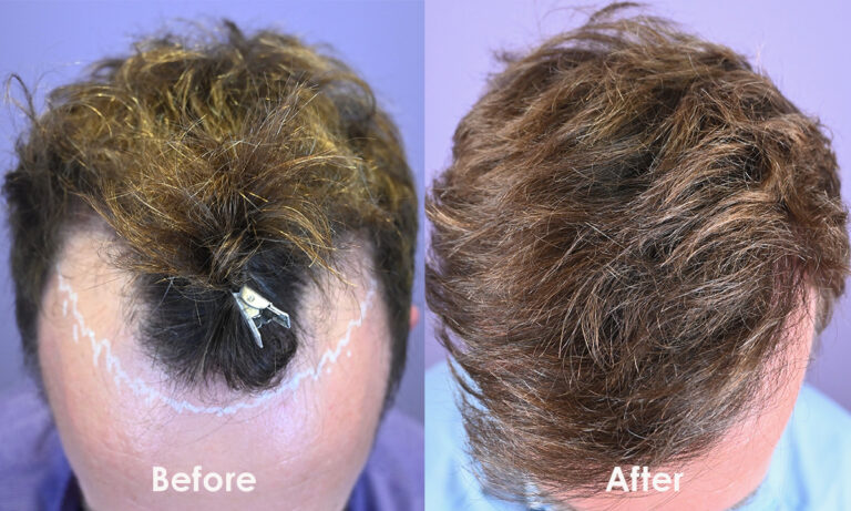 FUE Hair Transplant to Restore Patients Hairline and Confidence - Hair ...