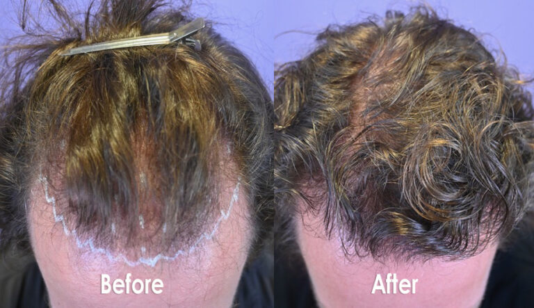 Hairline Restoration - 1 Session - 1500 Hair Grafts - Hair Restoration ...
