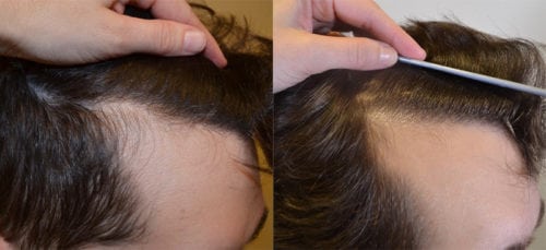 Finasteride Treatment for Hairline Restoration & Maintenance - Hair ...
